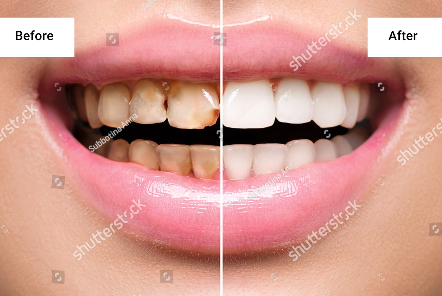 Smile Orthodontics | Invisalign & Braces in Norwich & Beyond